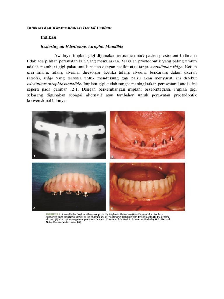 Indikasi Dan Kontraindikasi Dental Implan | PDF