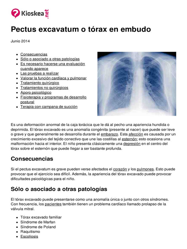 Pectus Excavatum o Torax en Embudo 14218 Mw5mzr | Tórax | Depresión ...