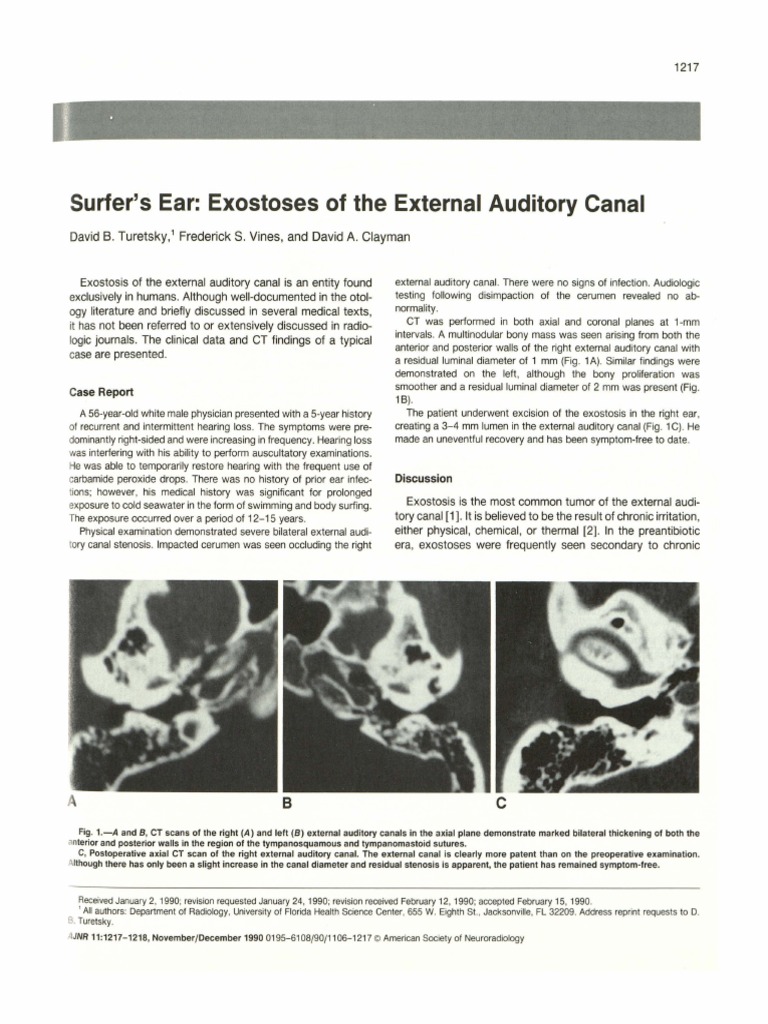 Urfer'S Ear: Exostoses of The External Auditory Canal: David B ...