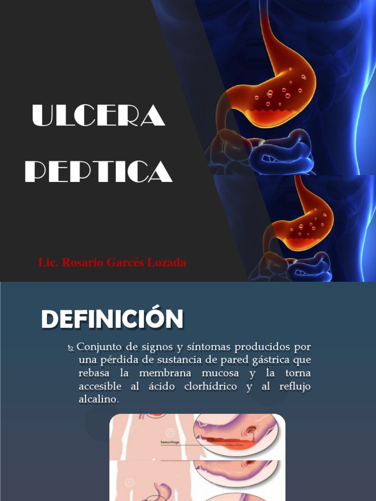 ULCERA PEPTICA | Estómago | Gastroenterología