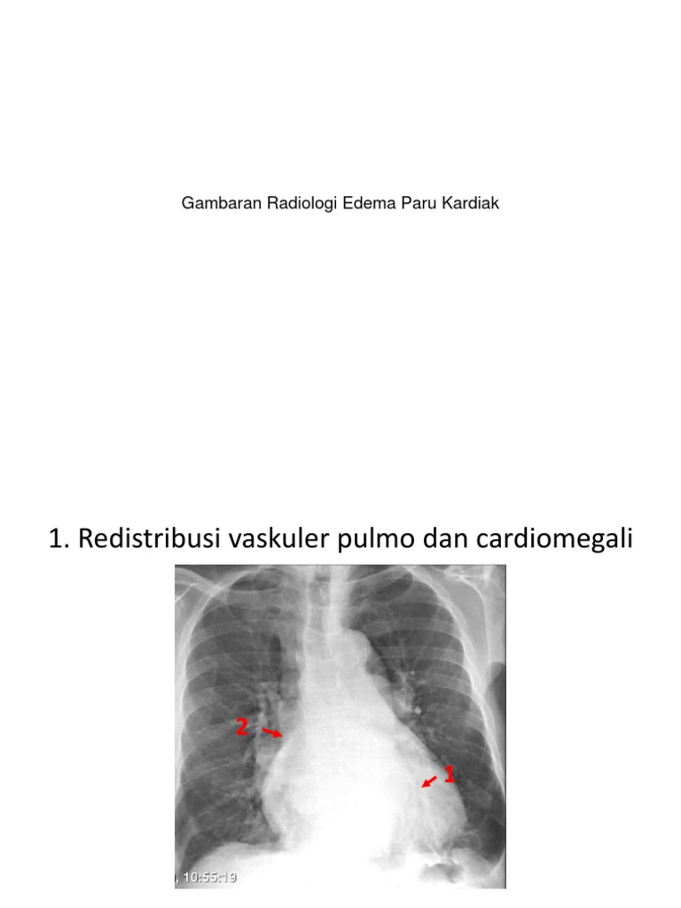 Gambaran Radiologi Edema Paru | PDF