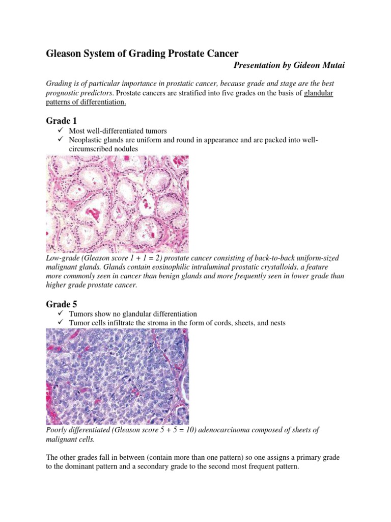 Gleason System of Grading Prostate Cancer | PDF | Medicine | Clinical ...