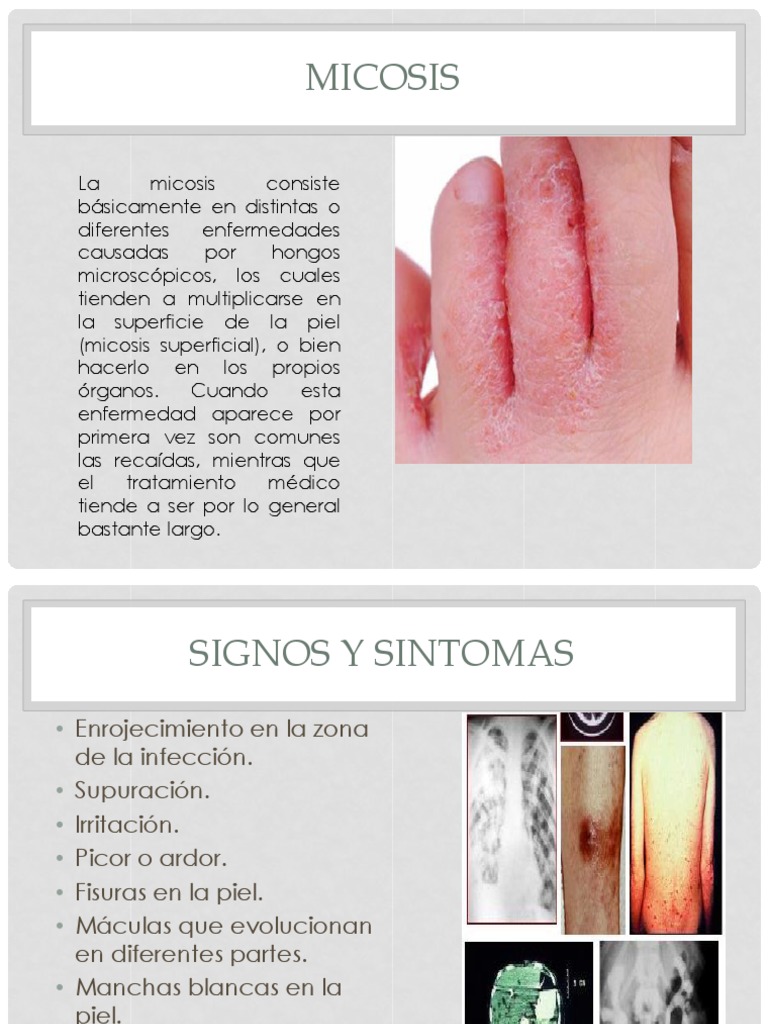 Micosis | PDF | Diagnostico medico | Medicina CLINICA