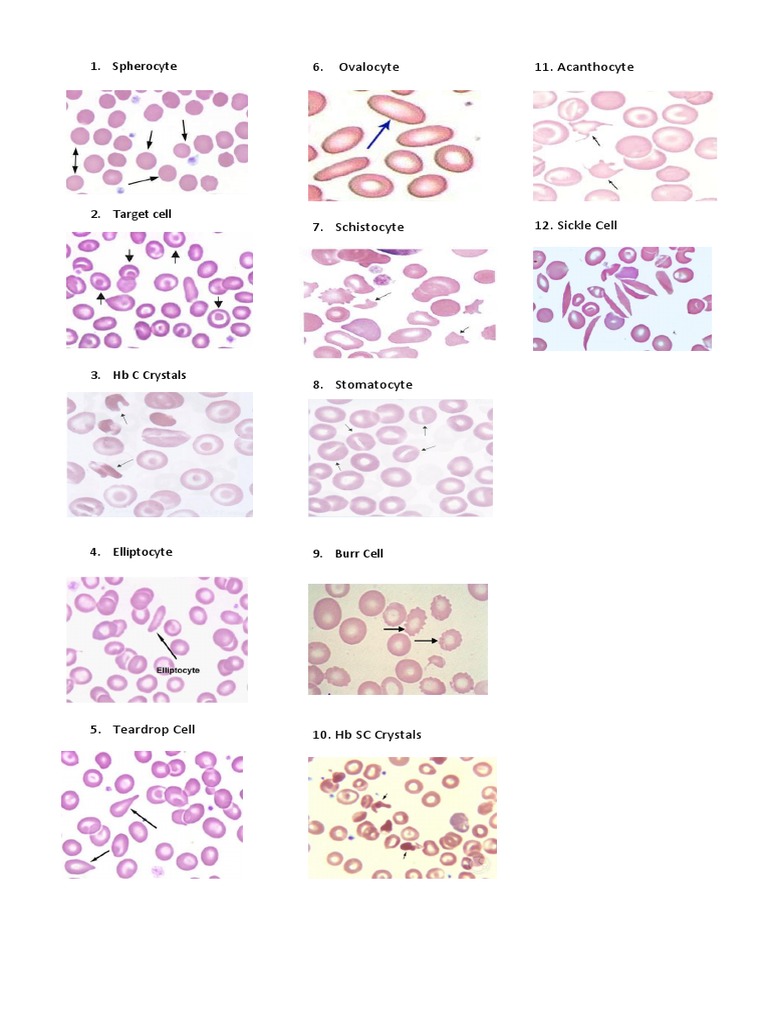 Ovalocyte 11. Acanthocyte: 1. Spherocyte | PDF