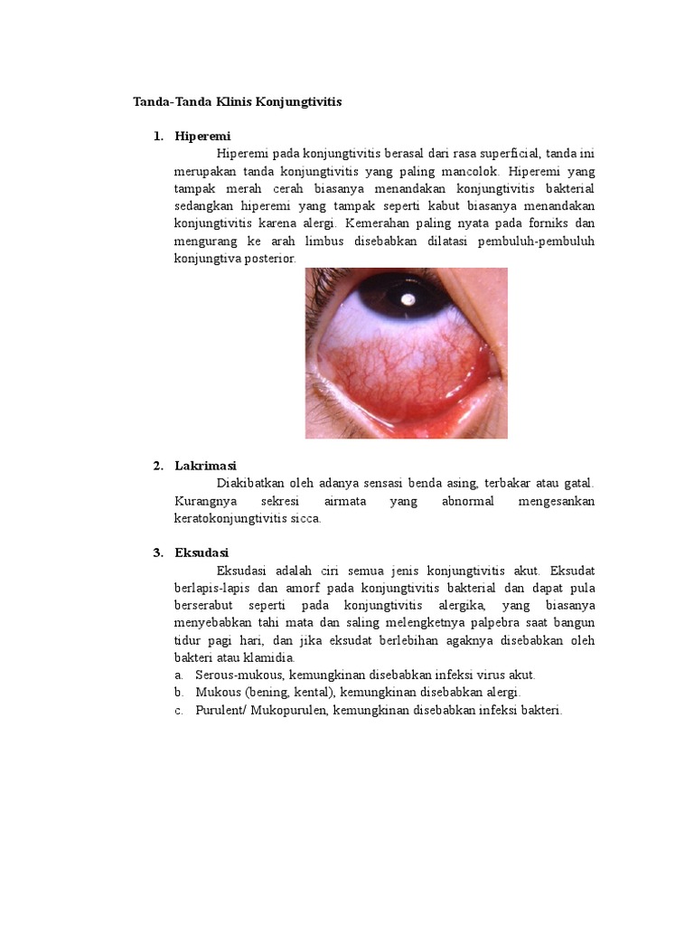 Tanda Klinis Konjungtivitis Mukopurulen | PDF