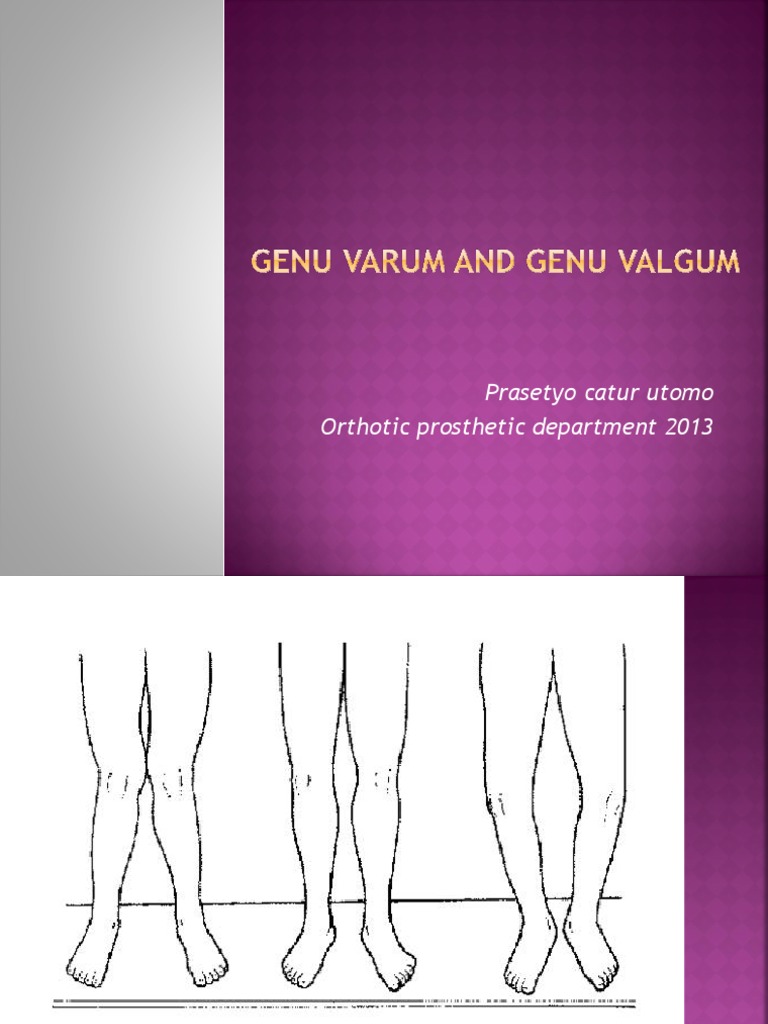 Genu Valgum and Varum: Causes and Conditions | PDF