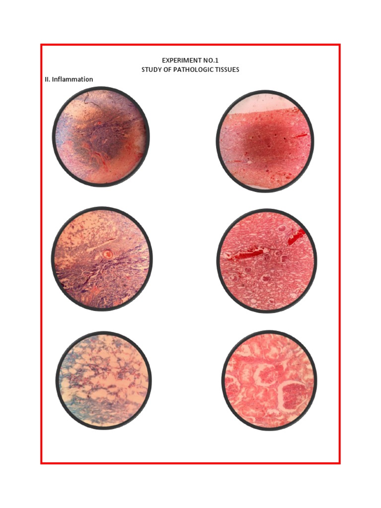 Pathologic Tissues: Inflammation & Neoplasia | PDF