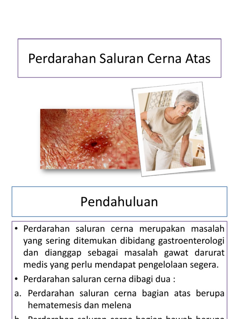 Perdarahan Saluran Cerna Atas | PDF