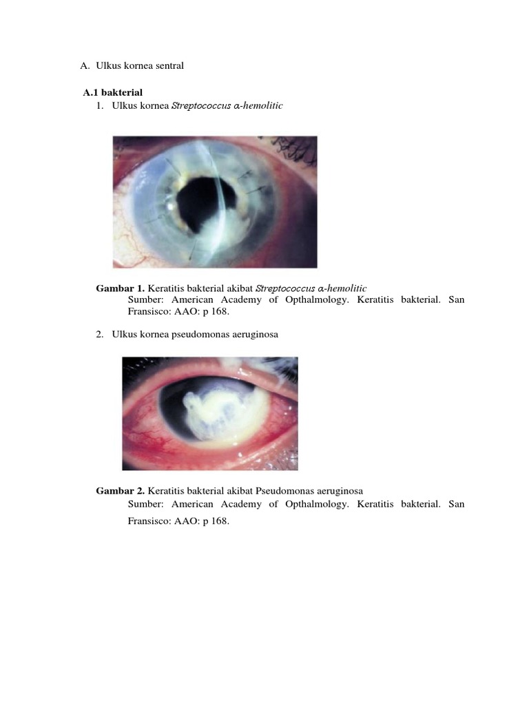 Jenis dan Gambar Ulkus Kornea | PDF