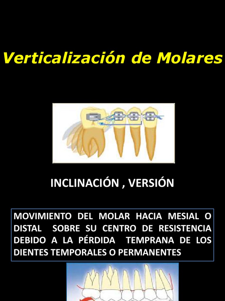 Verticalización de Molares con Cantilever | PDF | Ramas de Odontología ...