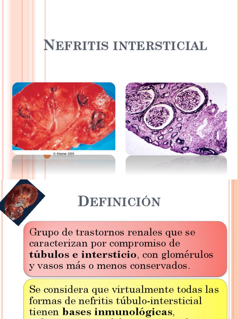 Nefritis | PDF | Riñón | Enfermedades y trastornos