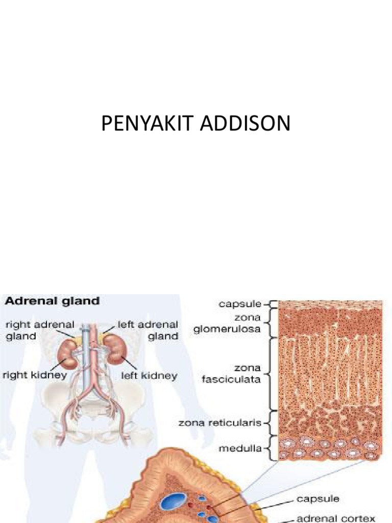 Addison Disease | PDF