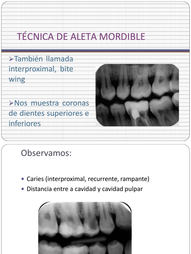 RX Bite Wing Odp | PDF