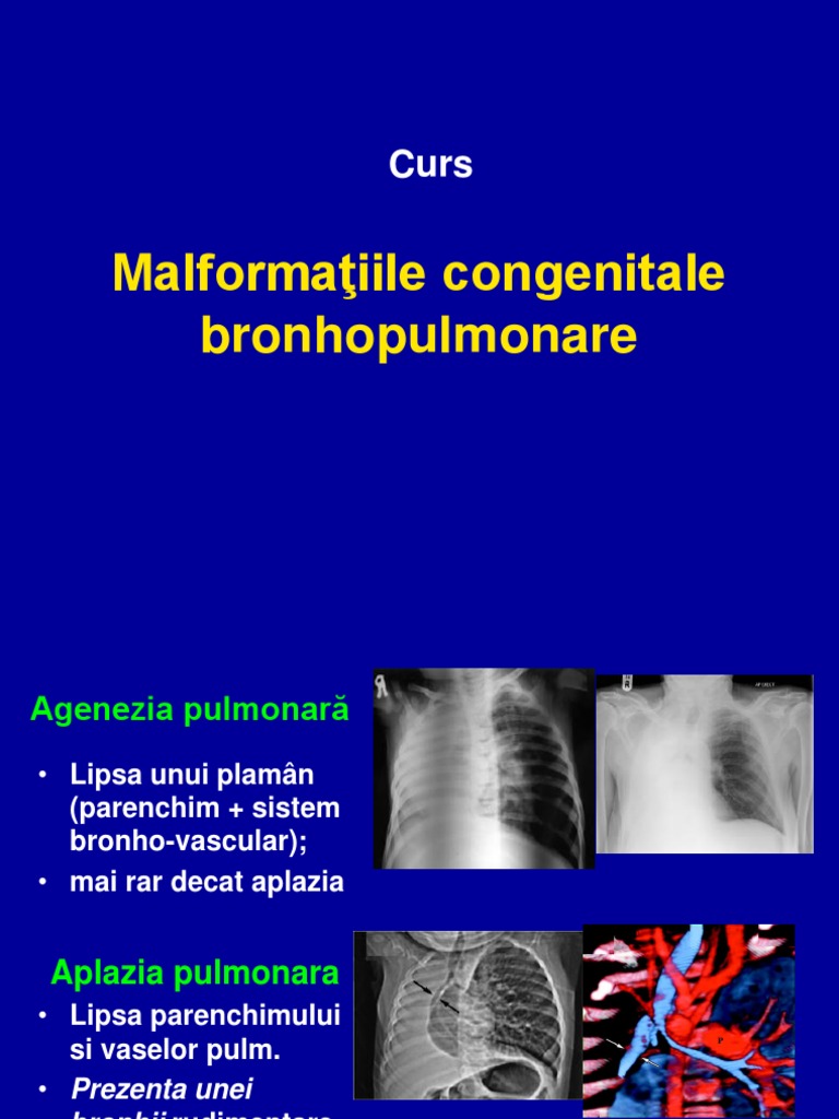 Malformatii Cong Bronho-Pulm ! | PDF