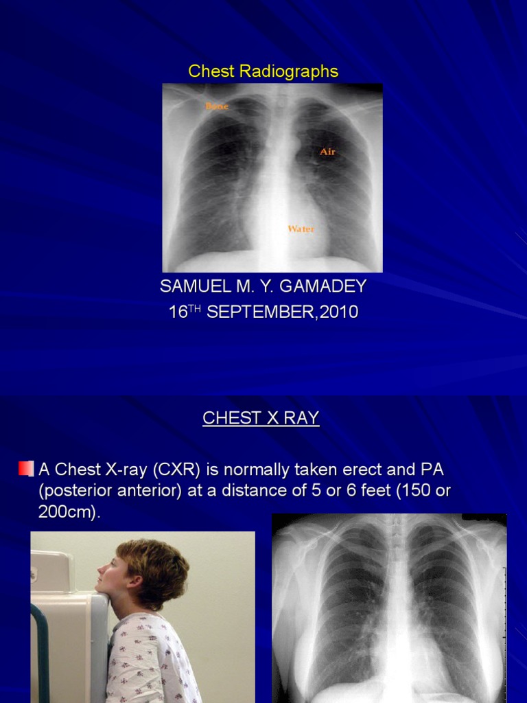 Plain Chest X Ray | Download Free PDF | Lung | Thorax (Human Anatomy)