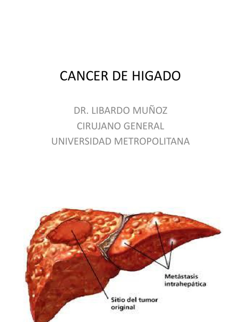 Cáncer de Hígado: Tipos y Tratamientos | PDF | Especialidades Medicas ...