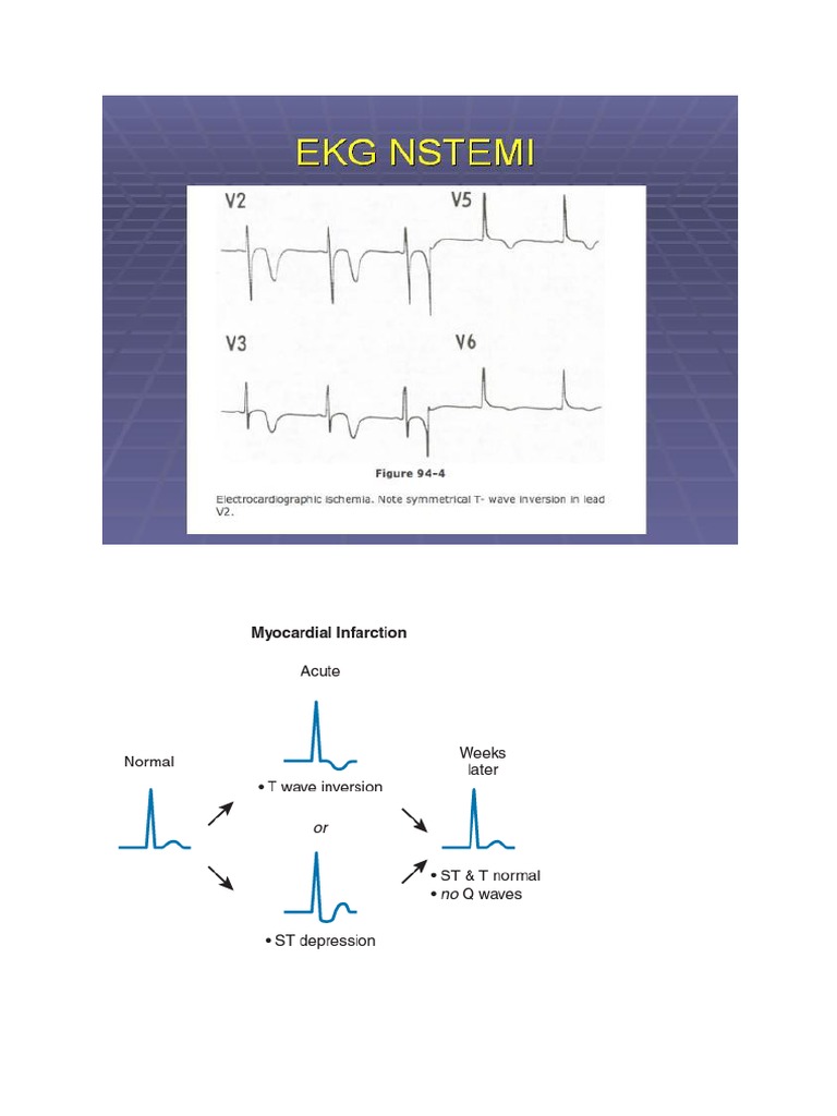 Gambar Ekg Nstemi | PDF