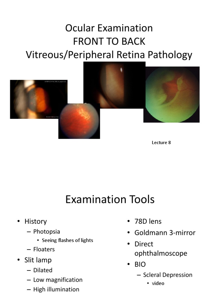 LECTURE 8 Vitreous - Peripheral Retina Pathology | PDF | Retina | Human Eye