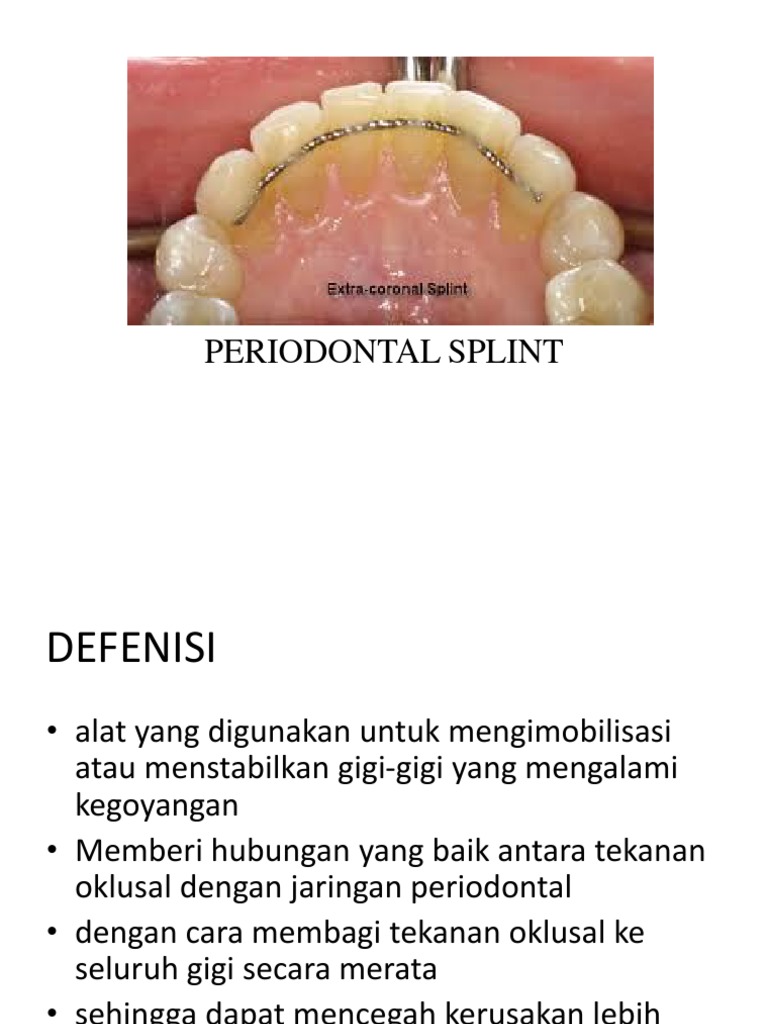Overview of Periodontal Splinting: Materials, Applications, and ...