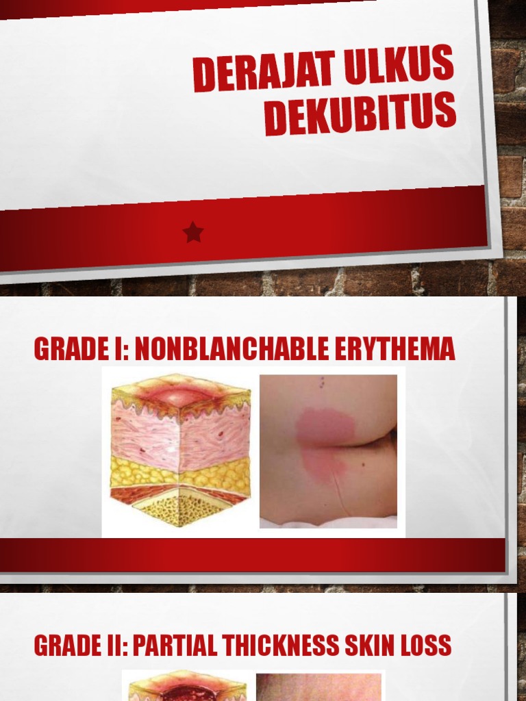 Grading Ulkus Dekubitus Levels | PDF | Mystery, Thriller & Crime Fiction