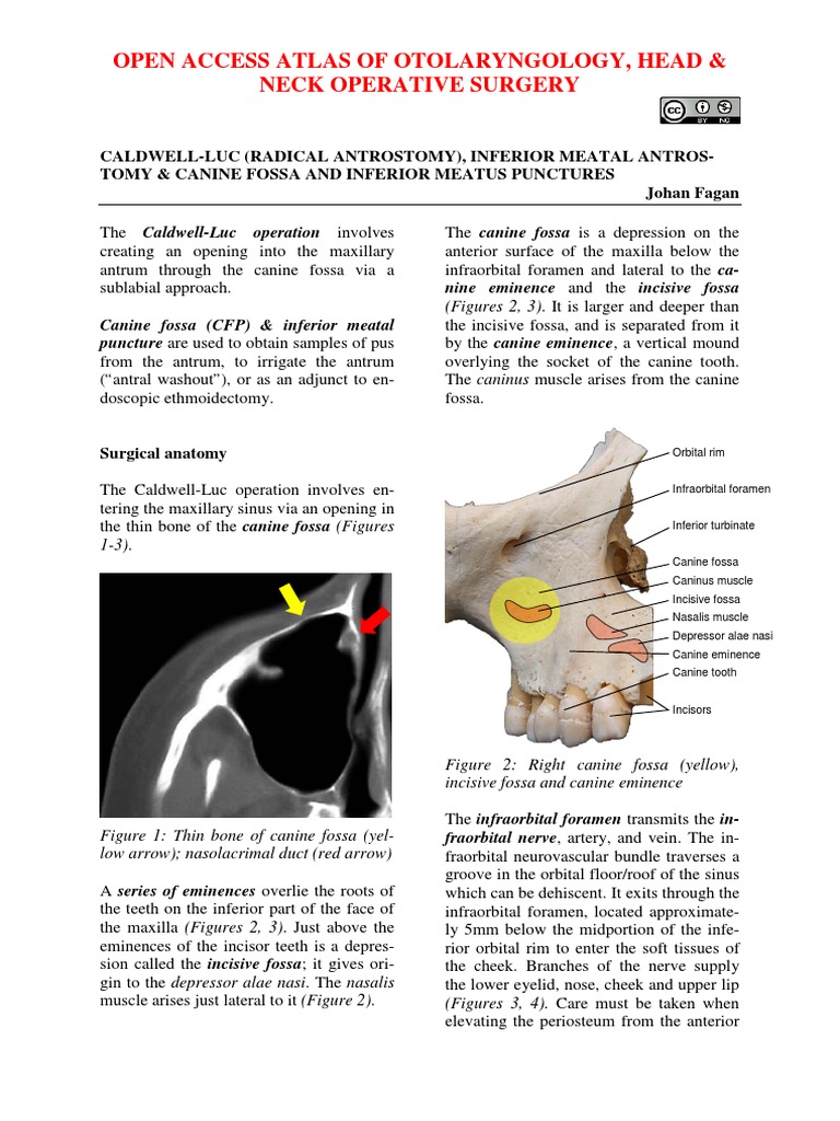 Caldwell Luc - Radical Antrostomy - Procedure Canine Fossa and Inferior ...