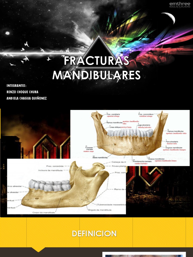 FRACTURAS MANDIBULARES | Odontología | Lesión