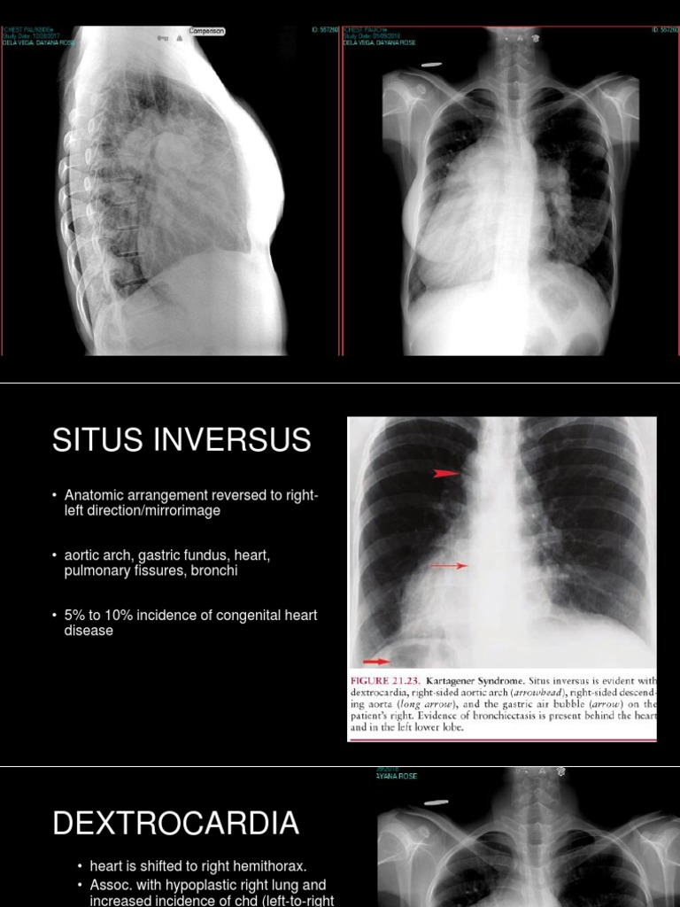 Dextrocardia | PDF
