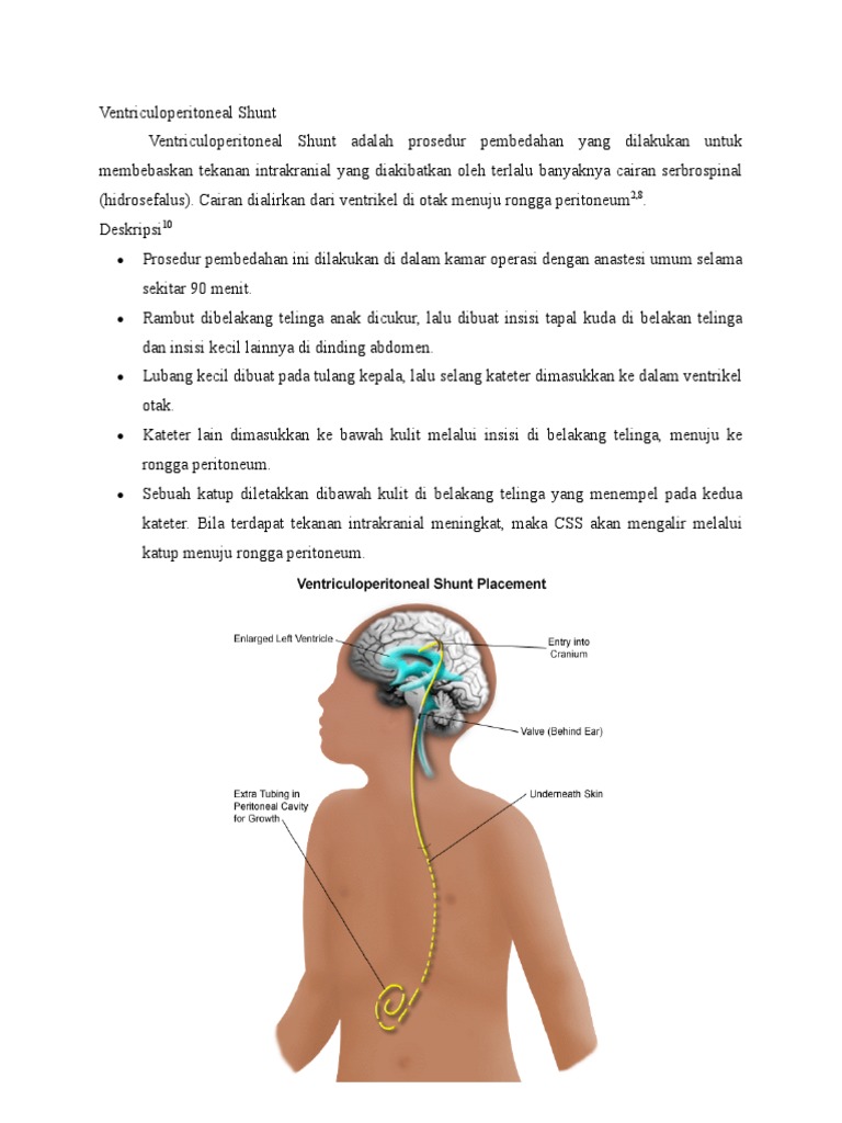 Ventriculoperitoneal Shunt | PDF