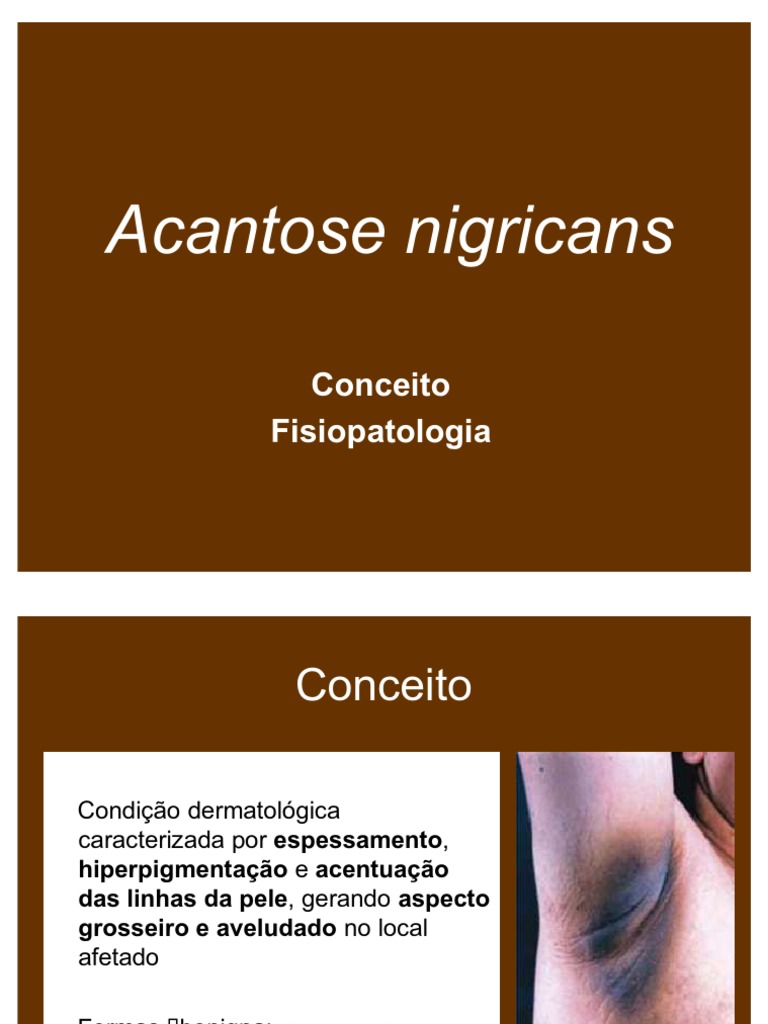Acantose Nigricans | PDF