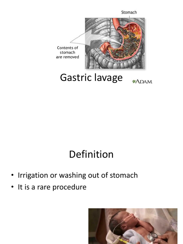 Procedural Guidelines for Gastric Lavage in Newborns and Infants | PDF ...