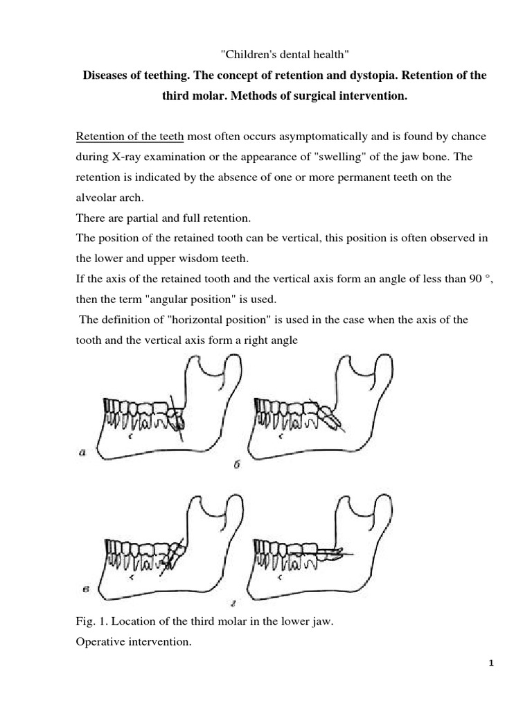 Disease of Teething Retension Dystopia Retension of 3rd Molar Methods ...