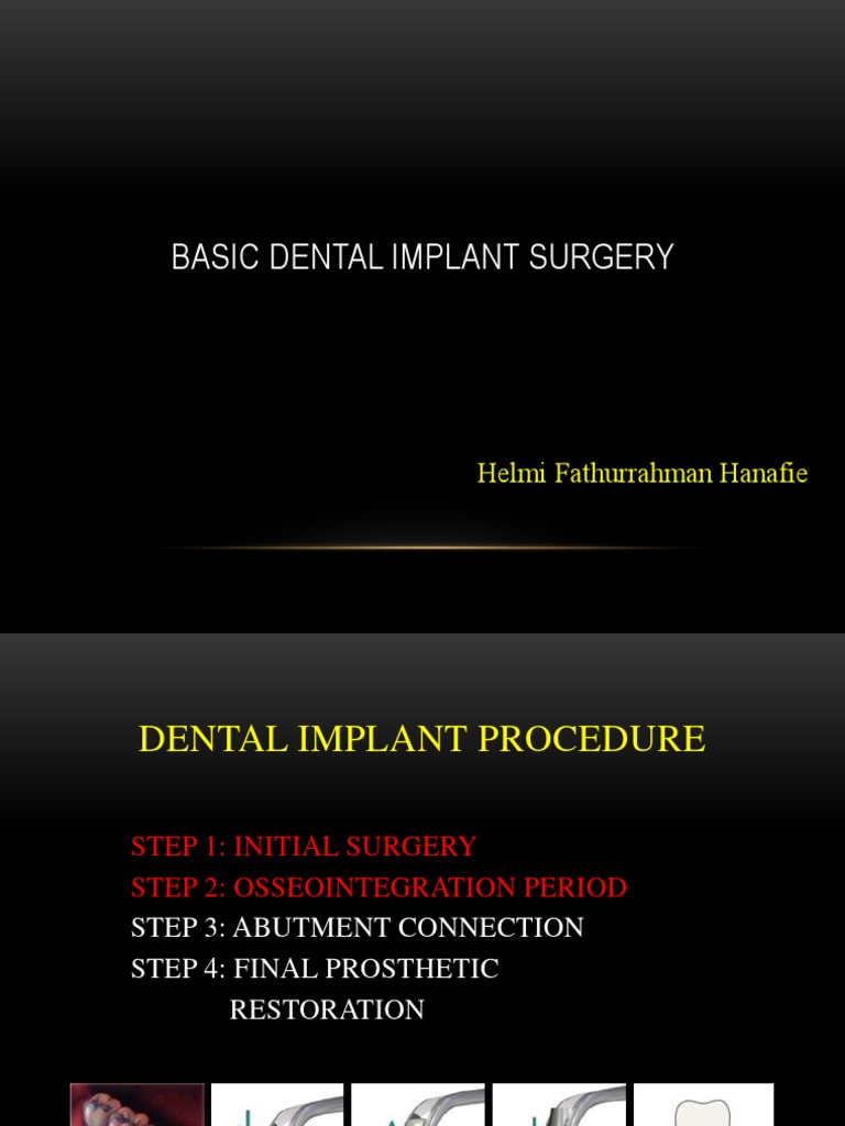 Step-by-Step Dental Implant Surgery | PDF | Dental Implant | Surgery
