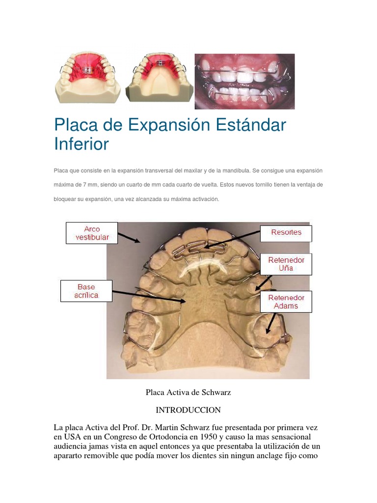 Placa de Expansión Estándar Inferior | Ortodoncia | Anatomia animal