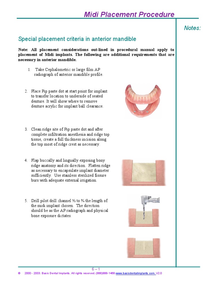 Chapter 6 Midi Implant Procedure | PDF | Dental Implant | Dentures