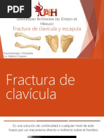 Clasificación de Fracturas de Clavícula Allman | PDF | Historia