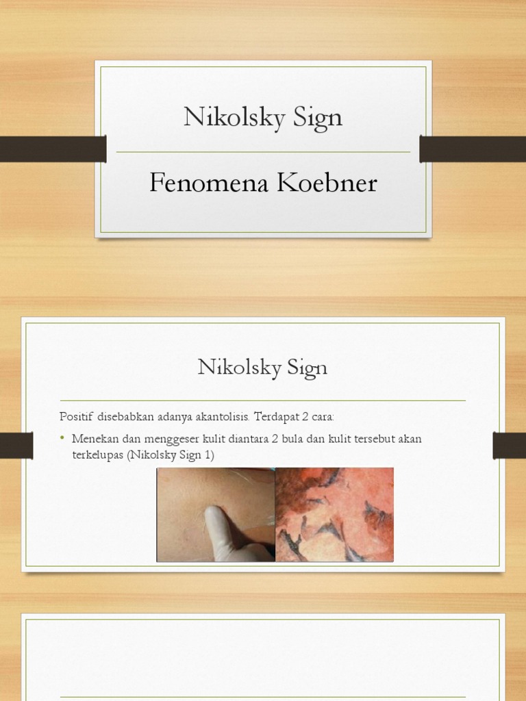 Nikolsky Sign and Koebner Phenomenon