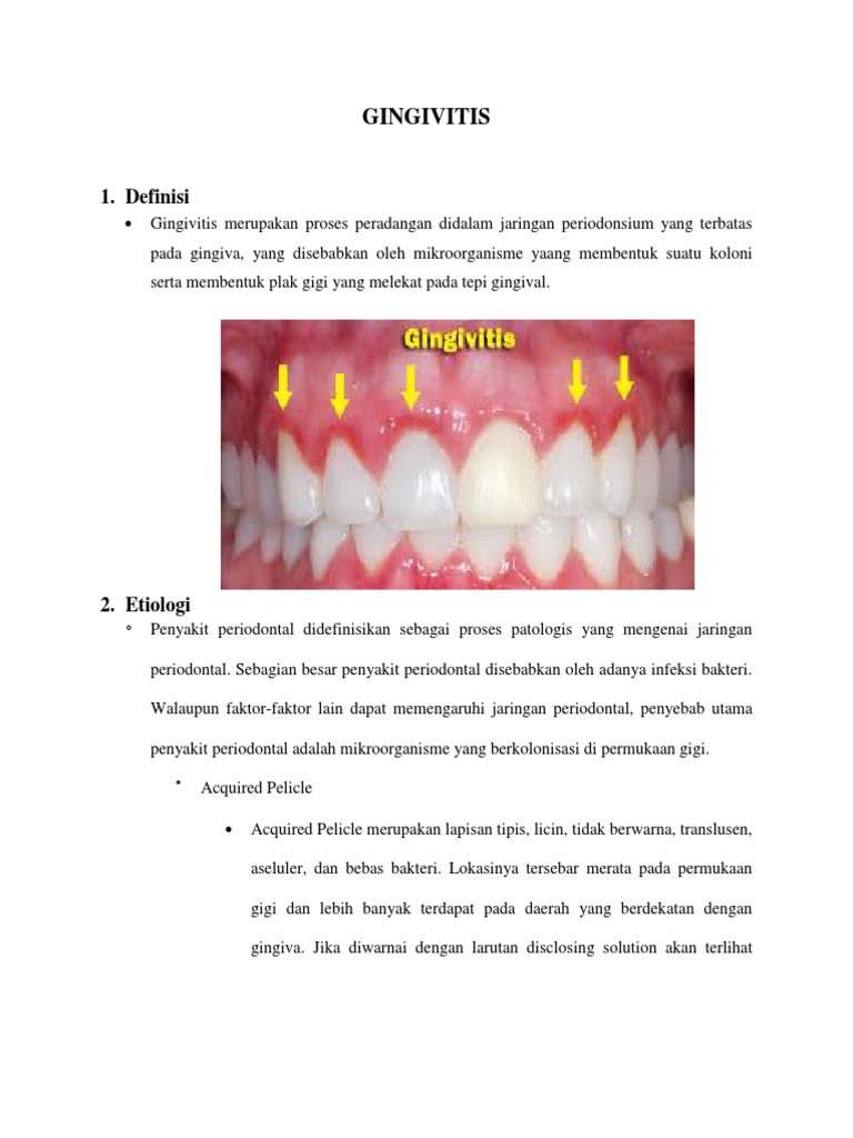 Gingivitis | PDF