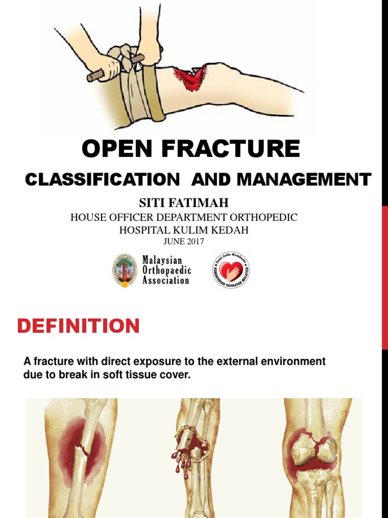 Classification And Management Of Open Fractures A Focus On Gustilos
