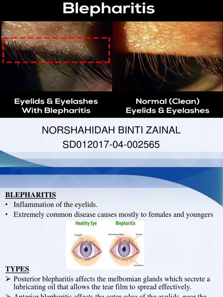 Blepharitis | PDF | Health Sciences | Medicine