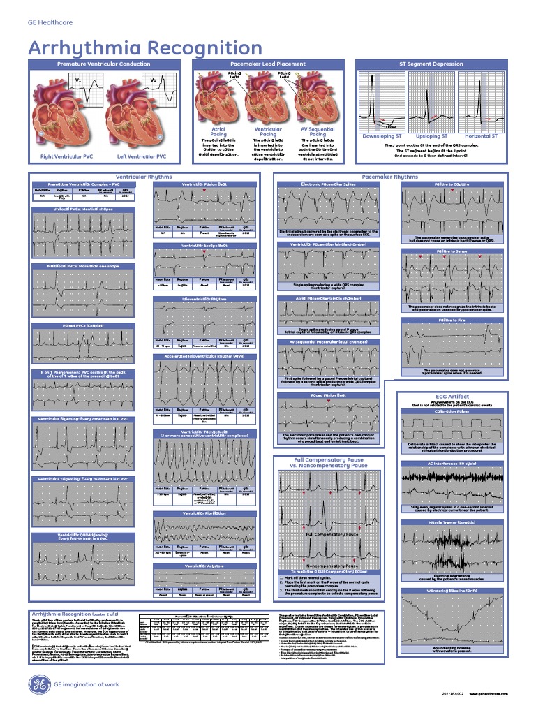Poster2 Arrhythmia Recognition e | PDF | Artificial Cardiac Pacemaker ...
