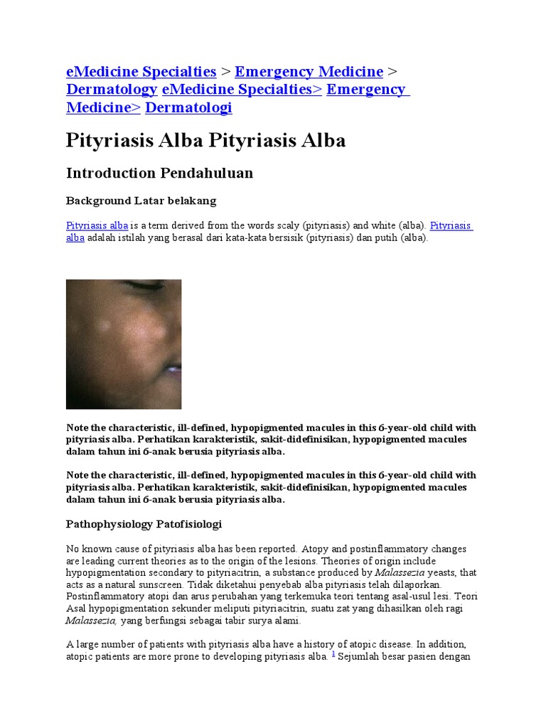 Pityriasis Alba Pityriasis Alba | PDF | Dermatitis | Medical Specialties