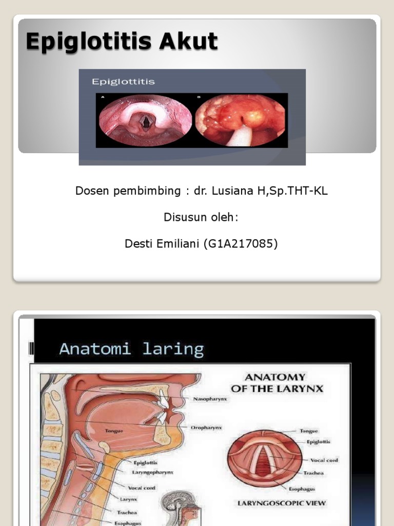 epiglotitis akut