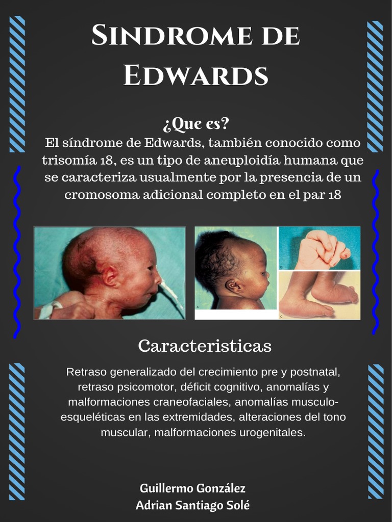 Sindrome de Edwards | PDF