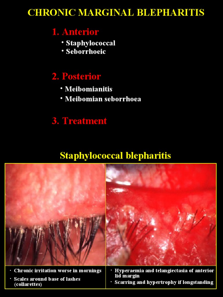Chronic Marginal Blepharitis Guide | PDF