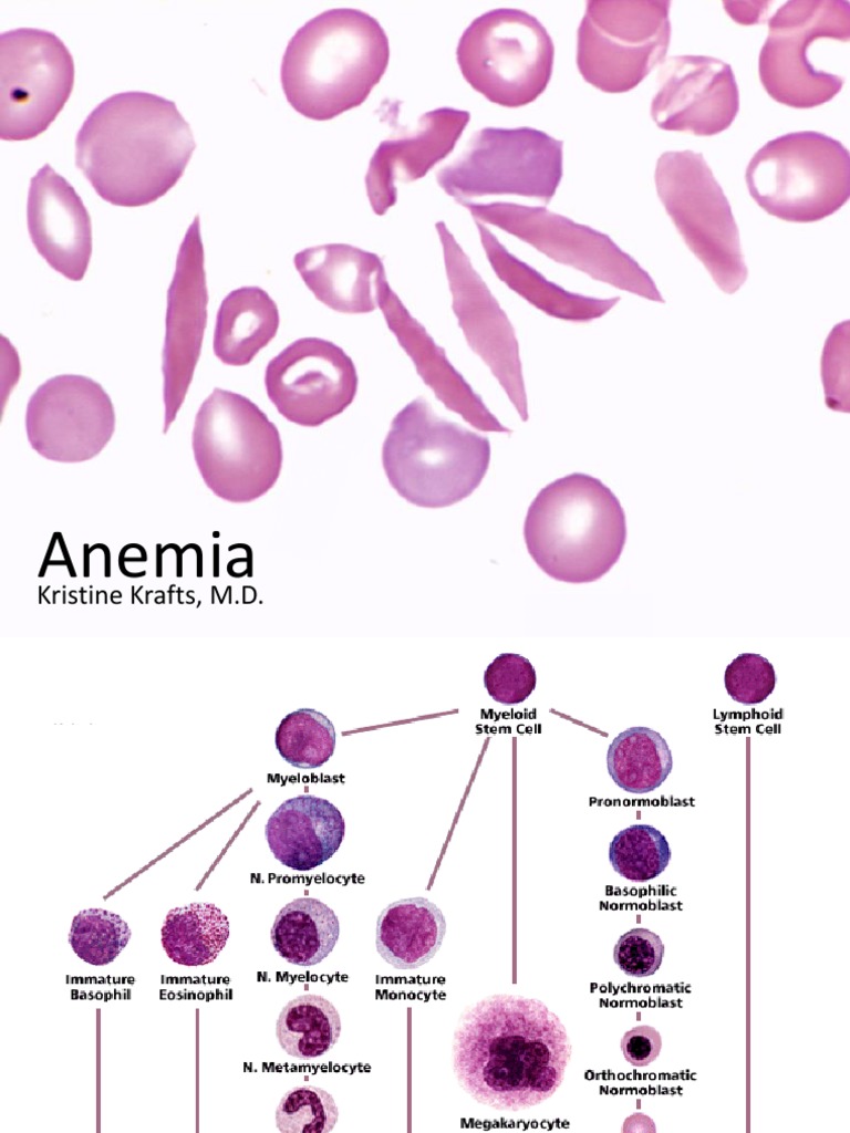Anemia: Kristine Krafts, M.D | PDF | Anemia | Tissue (Biology)