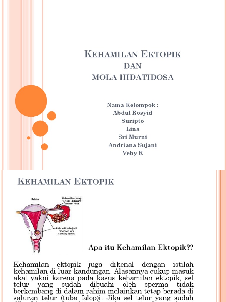 Power Point Kehamilan Ektopik | PDF