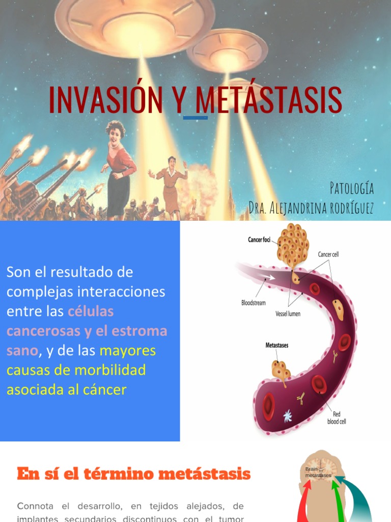 Invasión Y Metástasis: Patología Dra. Alejandrina rodríguez ...