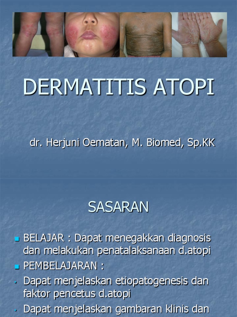 5056 - 220213 - Dermatitis Atopi Revisi 21 | PDF