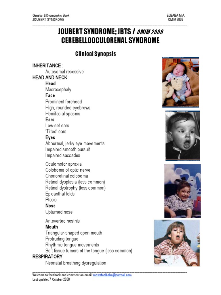 Joubert Syndrome | PDF | Diseases And Disorders | Medical Specialties
