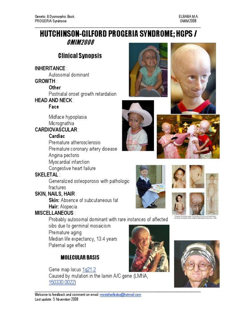 Hutchinson-Gilford Progeria Syndrome Hgps /: OMIM2008 | PDF